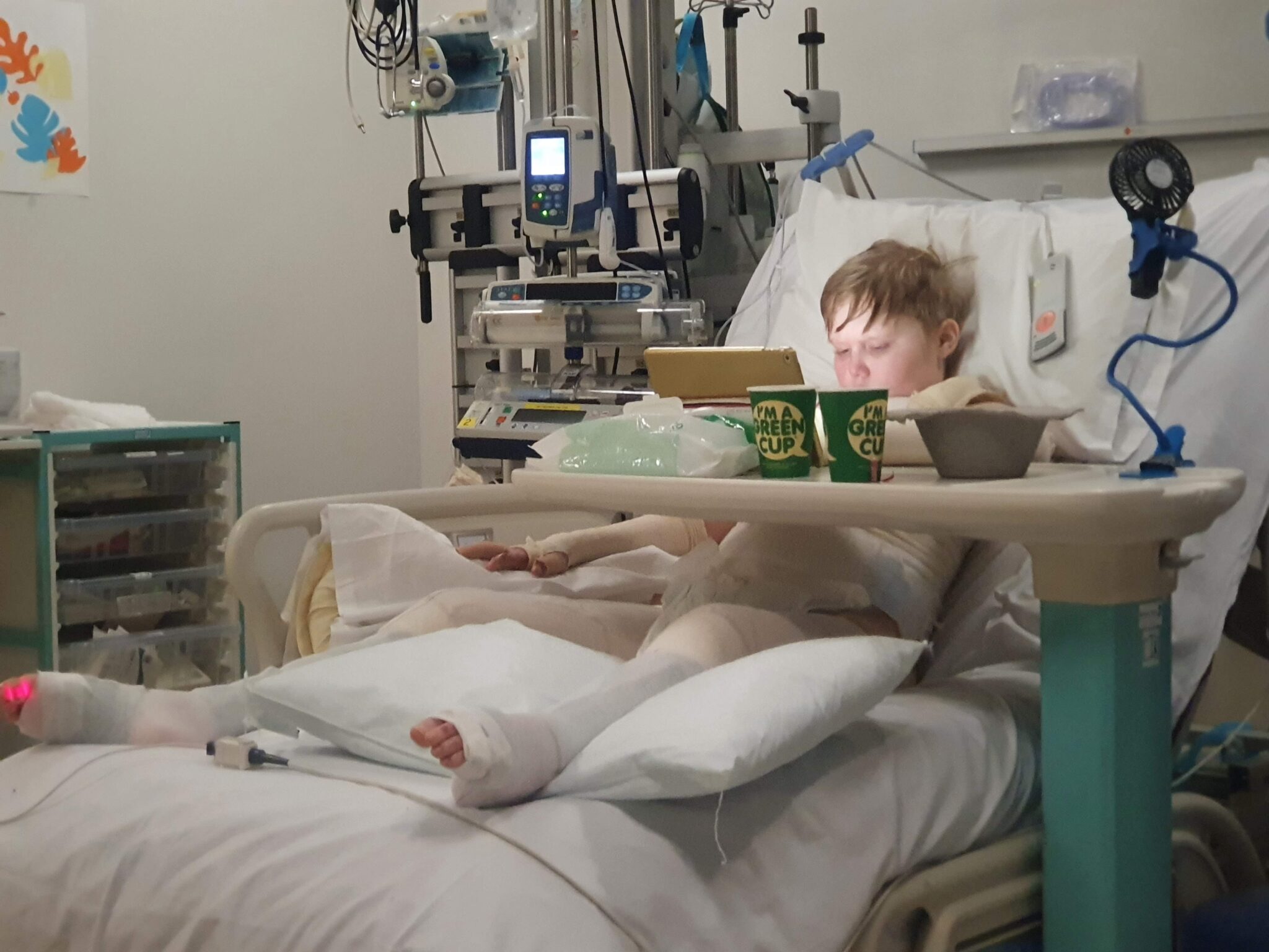 Teenager back to playing football after some of the most severe burns ...