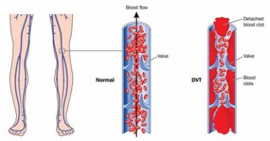 Scan to check for DVT (blood clot in the veins) - Manchester Royal ...